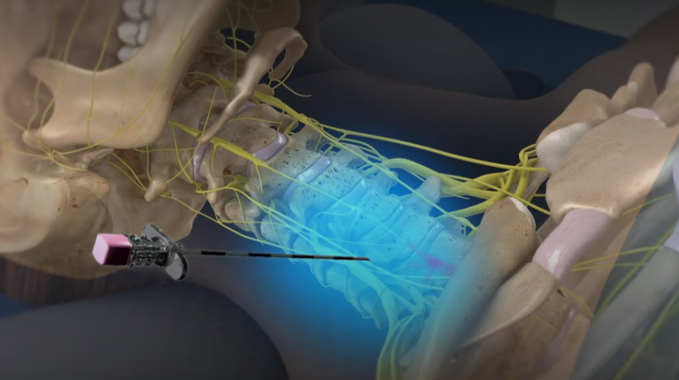 Stellate Ganglion Nerve Block - Physio Healing Therapy